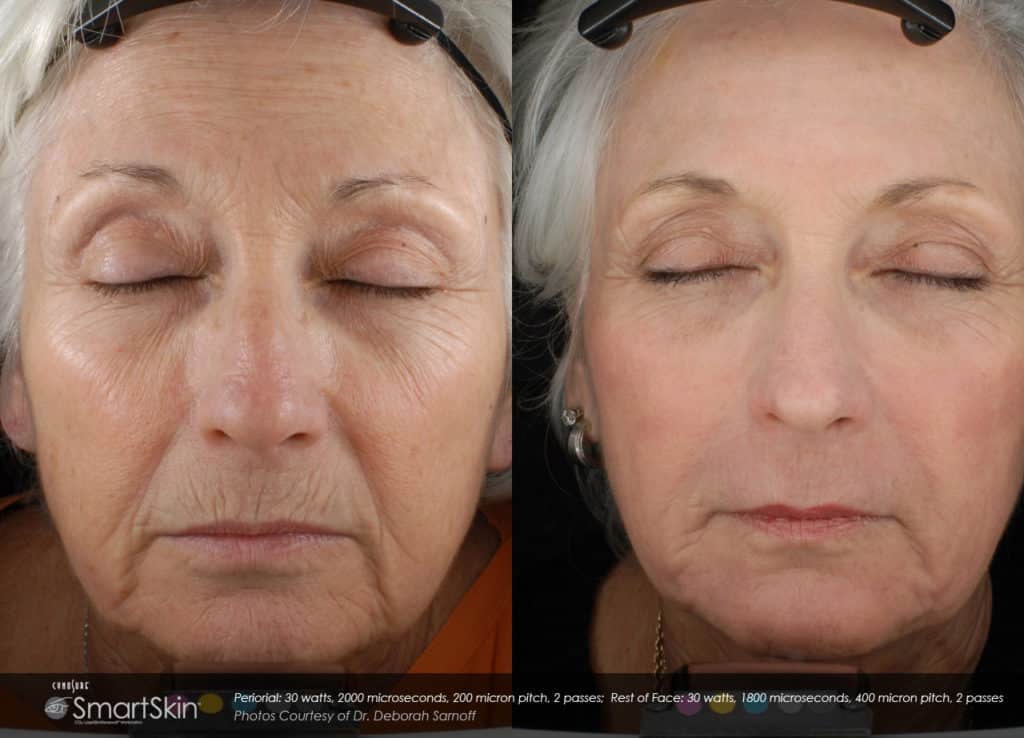 Get a new Skin with SmartSkin CO2 Fractional Resurfacing