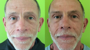 Bellafill Seattle | Long-Lasting Filler at Well Medical Arts