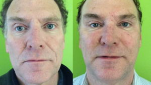 Bellafill Seattle | Long-Lasting Filler at Well Medical Arts