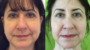 Bellafill Seattle | Long-Lasting Filler at Well Medical Arts