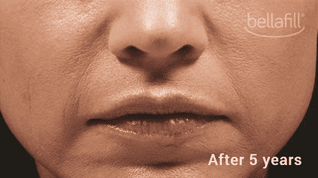 Bellafill after 5 years - Well Medical Arts: West Seattle's Medispa ...