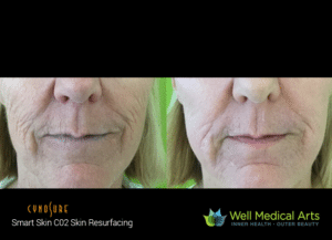 Get a new Skin with SmartSkin CO2 Fractional Resurfacing