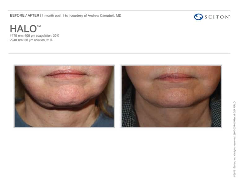 Treat fine lines and wrinkles with the HALO in Seattle at Well Medical Arts