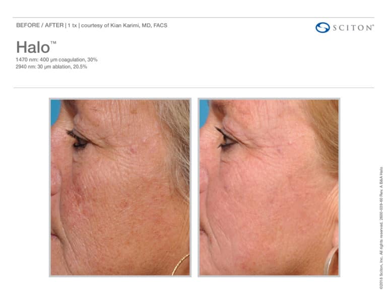Treat fine lines and wrinkles with the HALO in Seattle at Well Medical Arts
