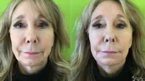 Bellafill Seattle | Long-Lasting Filler at Well Medical Arts