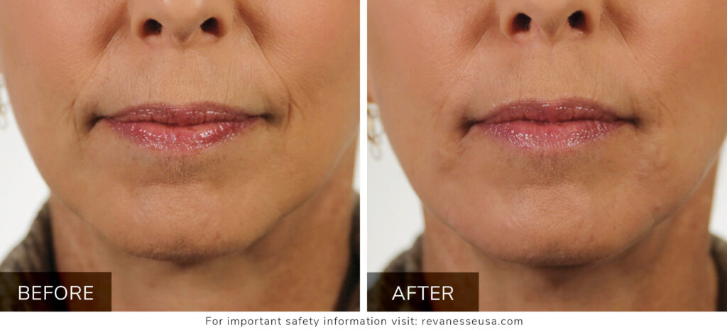 Versa dermal filler in Seattle at Well Medical Arts