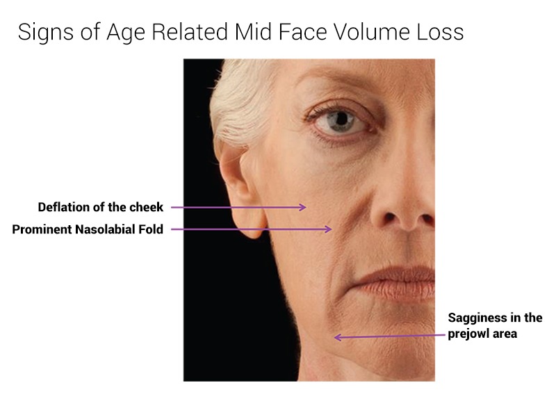 Sign of Age Related Mid Face Volume LOss Seattle Well Medical Arts ...
