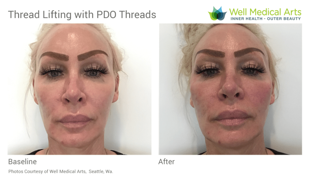 PDO Threads before and after in Seattle at Well Medical Arts