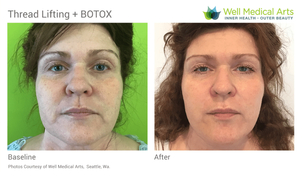 Thread lifting in Seattle at Well Medical Arts