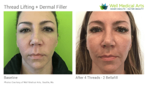 Thread lifting in Seattle at Well Medical Arts