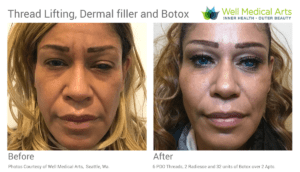 Thread lifting in Seattle at Well Medical Arts