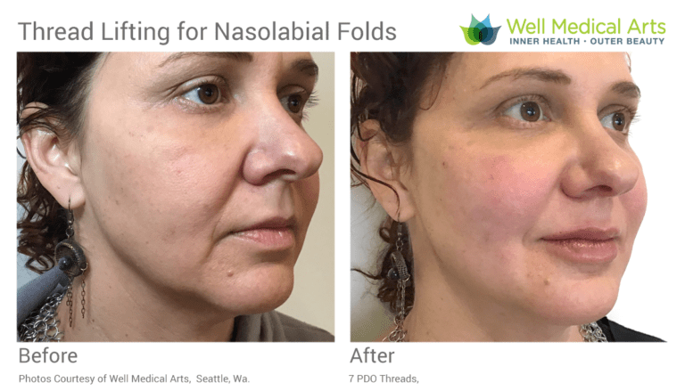 Thread lifting in Seattle at Well Medical Arts