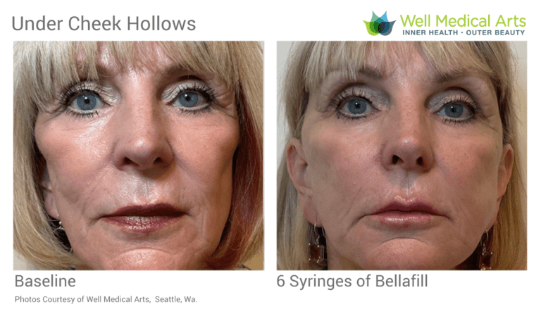 Fill Hollow Cheeks with Bellafill Dermal Filler at Well Medical Arts