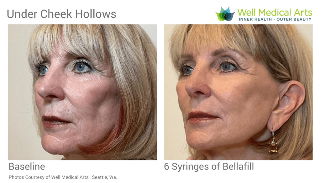 Fill Hollow Cheeks with Bellafill Dermal Filler at Well Medical Arts