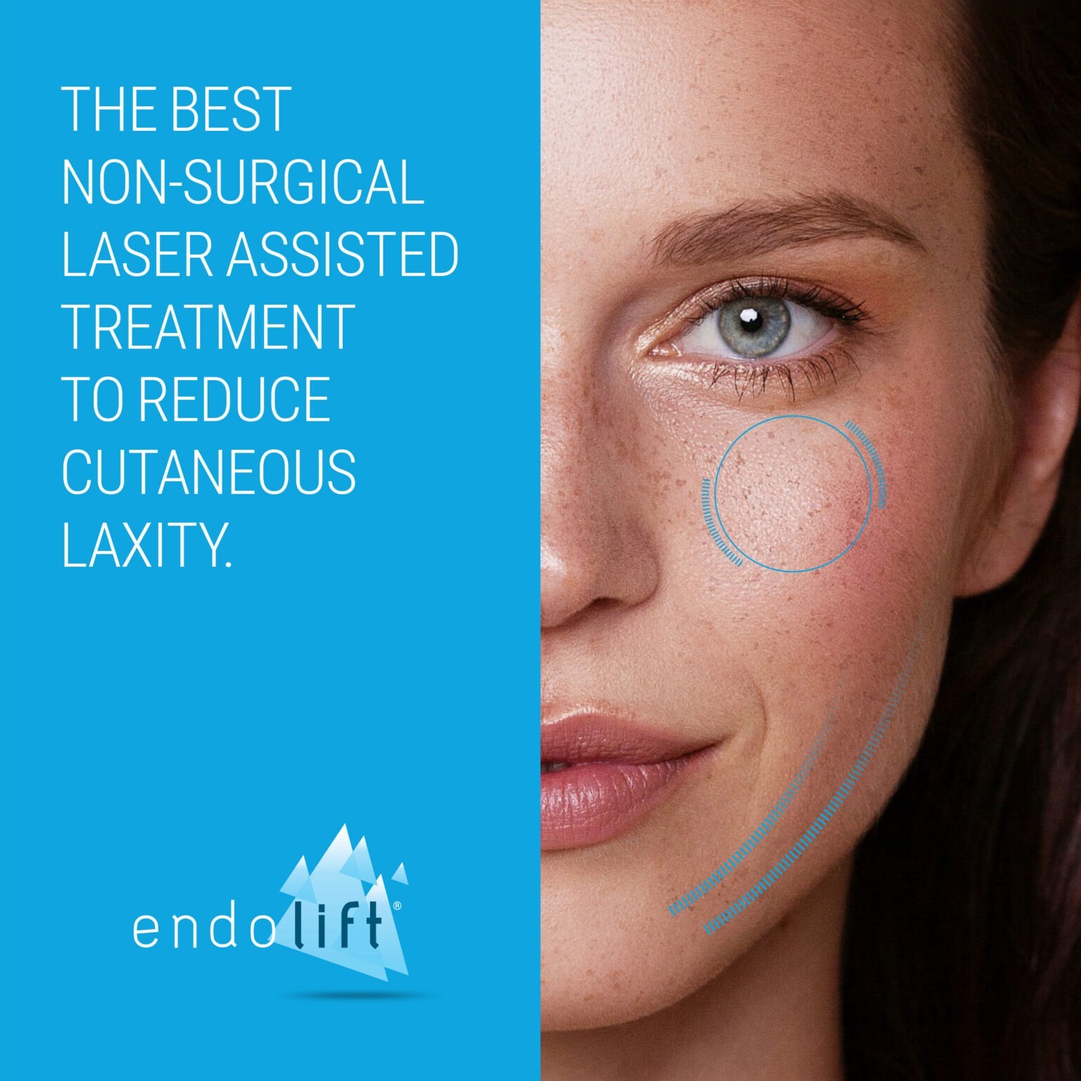 Endolift tightens skin and reduces fat in Seattle at Well Medical Arts