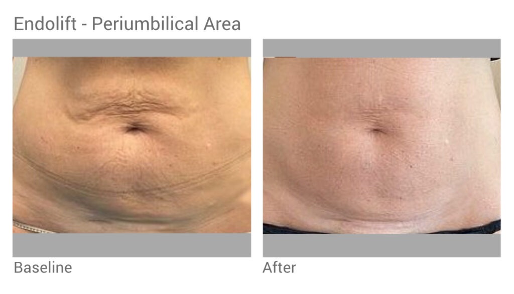 Endolift tightens skin and reduces fat in Seattle at Well Medical Arts