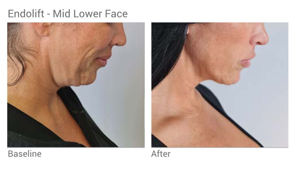 Endolift tightens skin and reduces fat in Seattle at Well Medical Arts