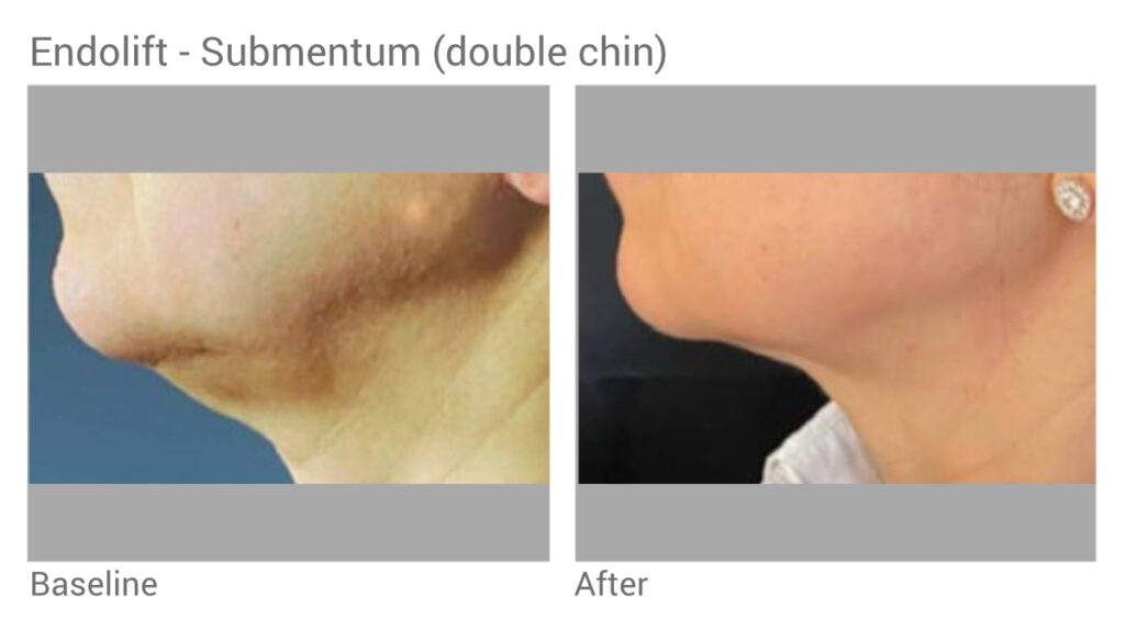 Endolift tightens skin and reduces fat in Seattle at Well Medical Arts